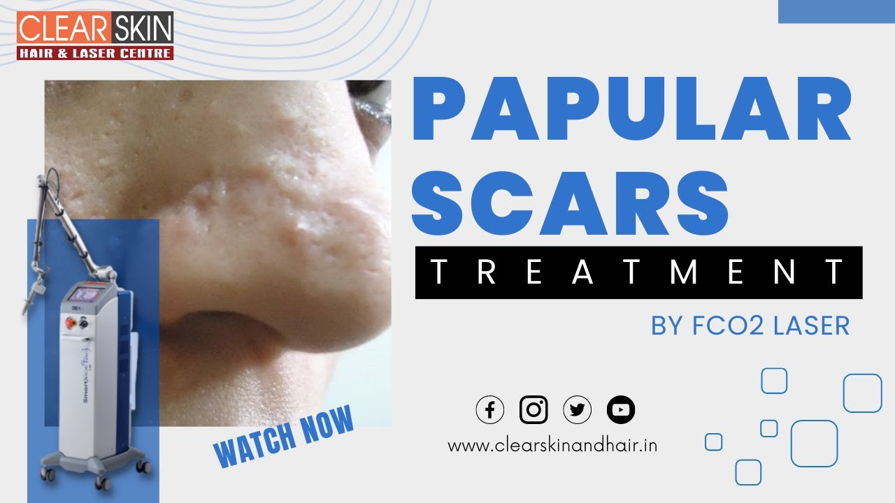 Popular Acne Scar treatment by Co2 laser || CO2 Laser Treatment For ...