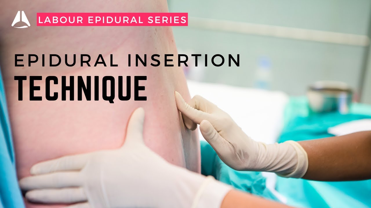 The Epidural Insertion | #anesthesiology #anesthesia #analgesia # ...