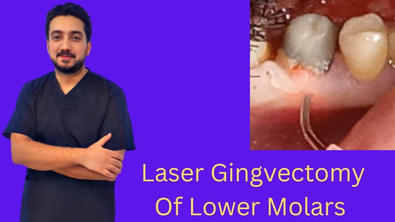 Laser Gingivectomy Of Lower Right Molars - YouTube