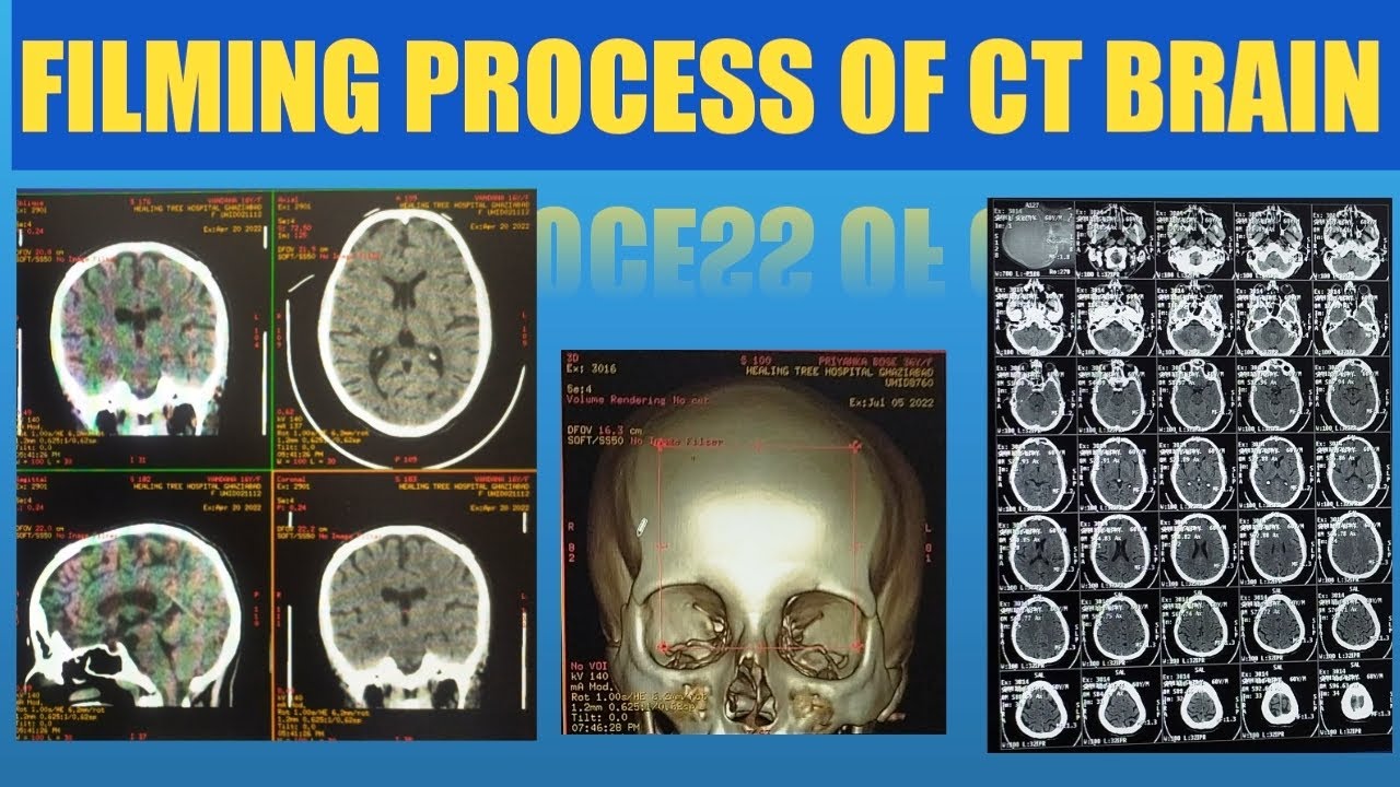NCCT BRAIN FILMING PROCESS #CT HEAD FILMING #NCCT HEAD FILMING - YouTube