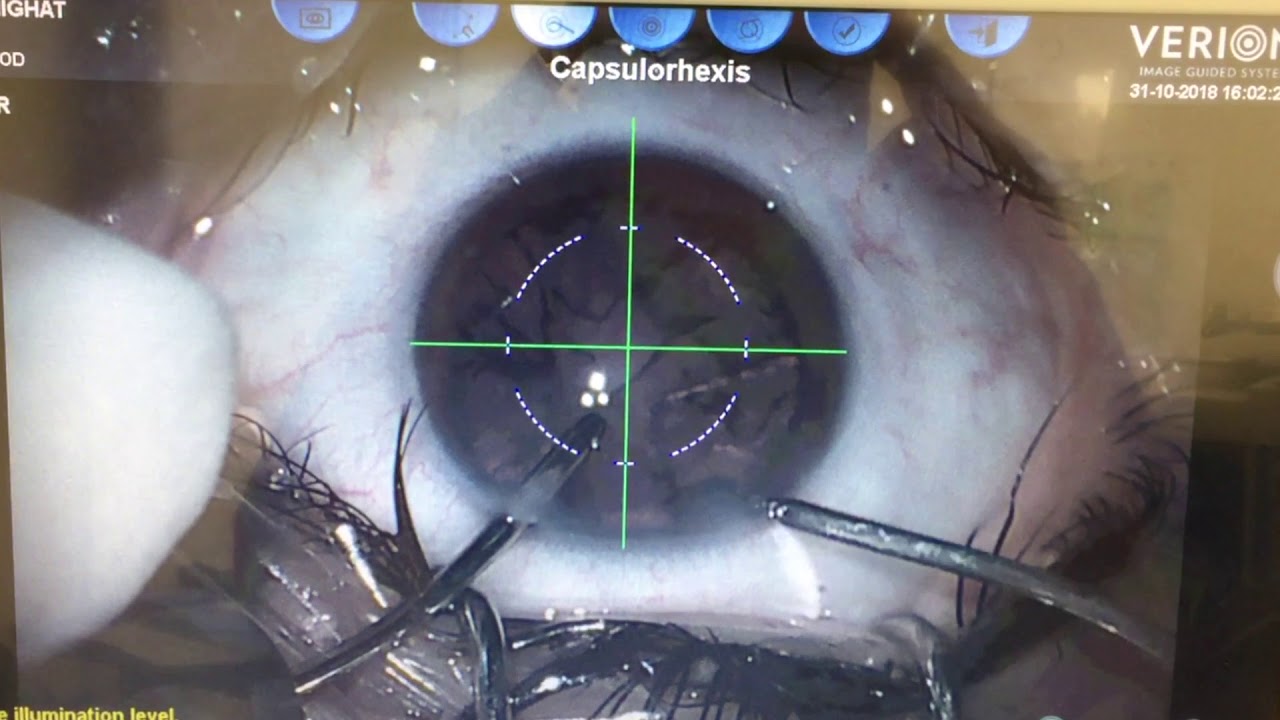 Verion guided Panoptic toric IOL by Dr Amer Awan - YouTube