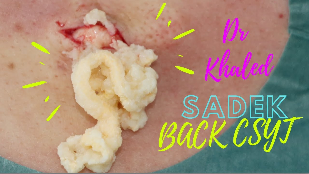 Juicy Back Cyst Remova. Dr Khaled Sadek. LipomaCyst.com - YouTube