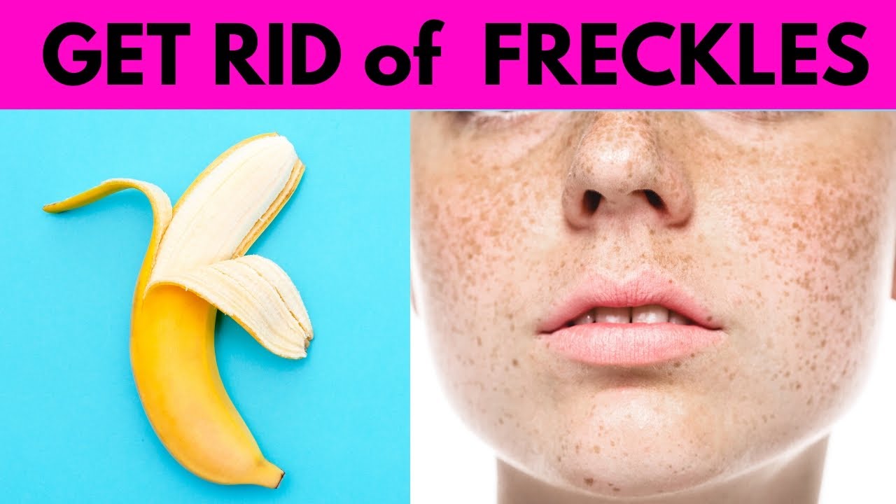how to get rid of freckles Naturally fast ( Proven Home remedies ...