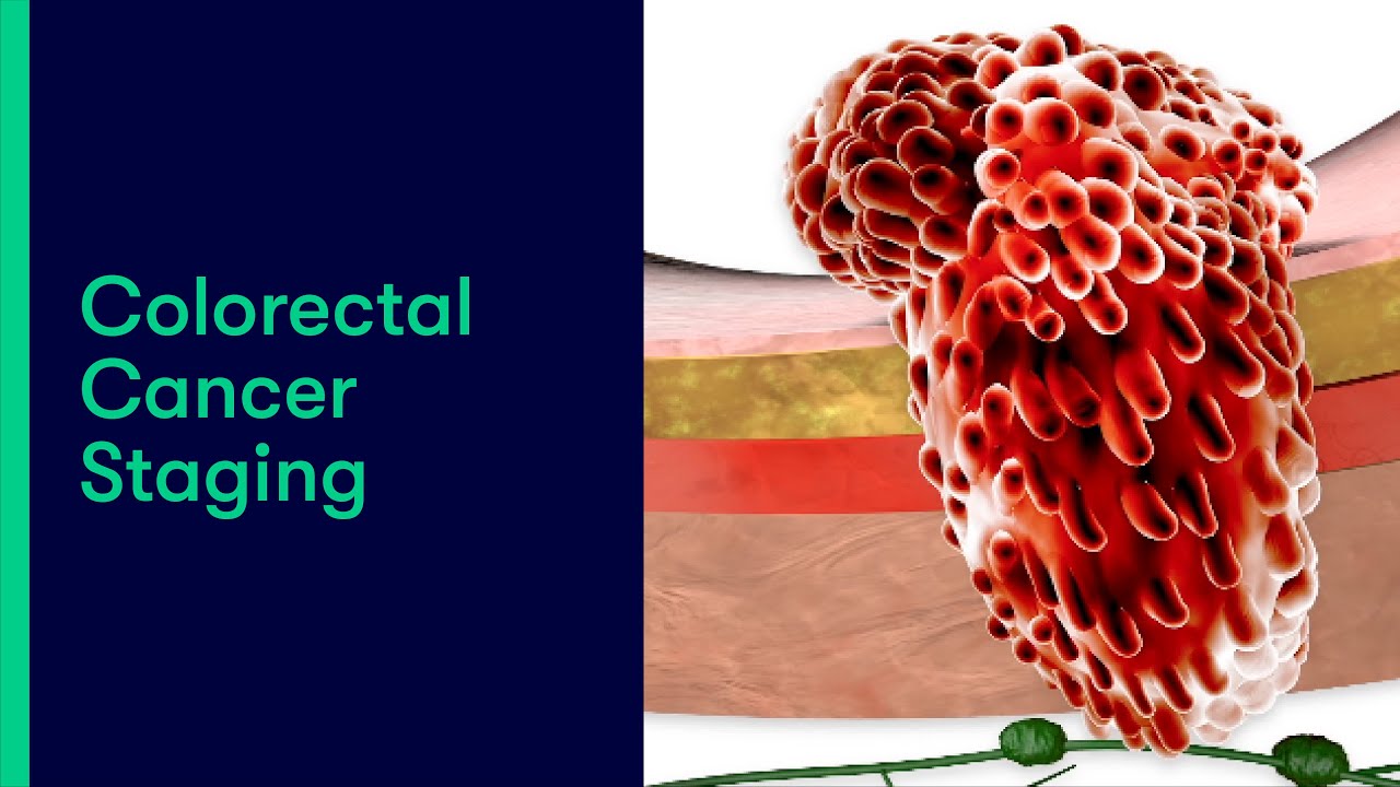 Rectal Cancer Staging