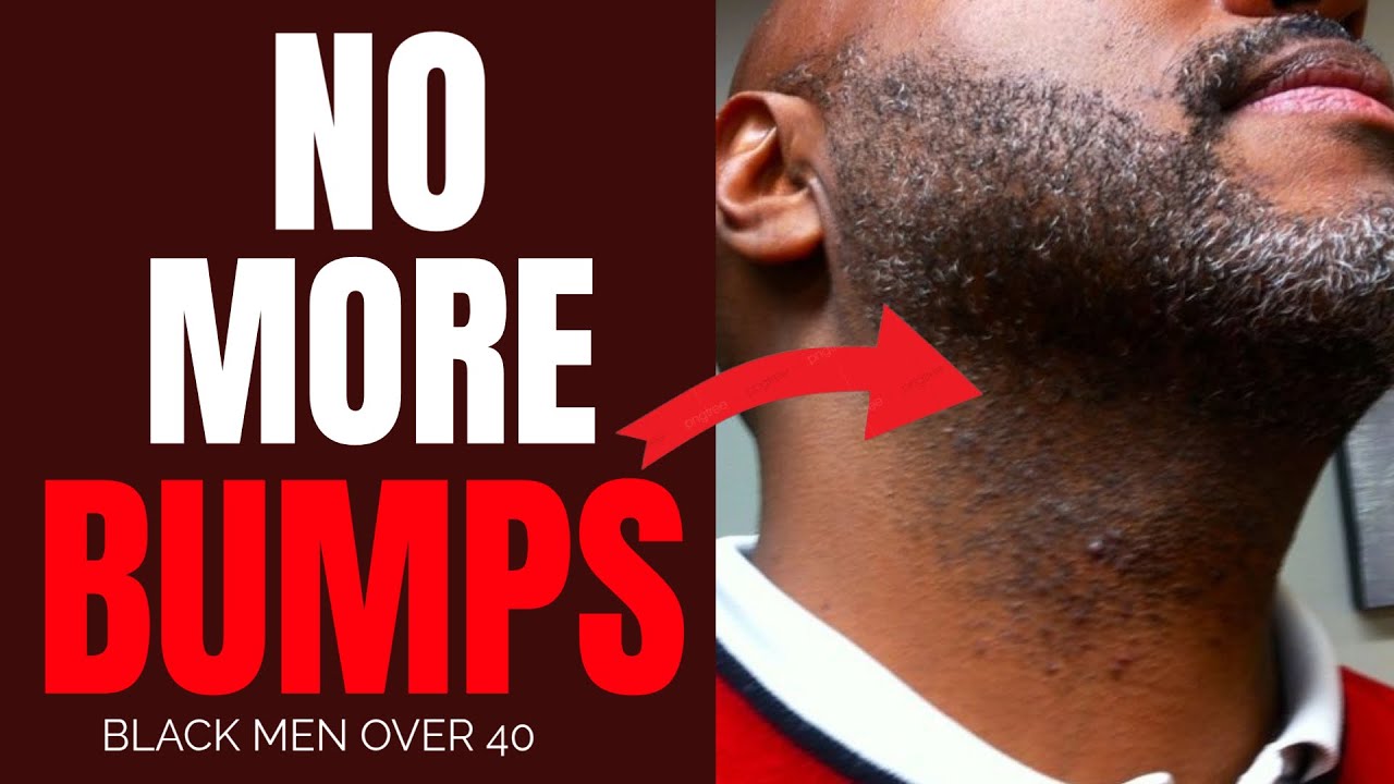 Beard Bumps? Do This (For Black Men Over 40) - YouTube
