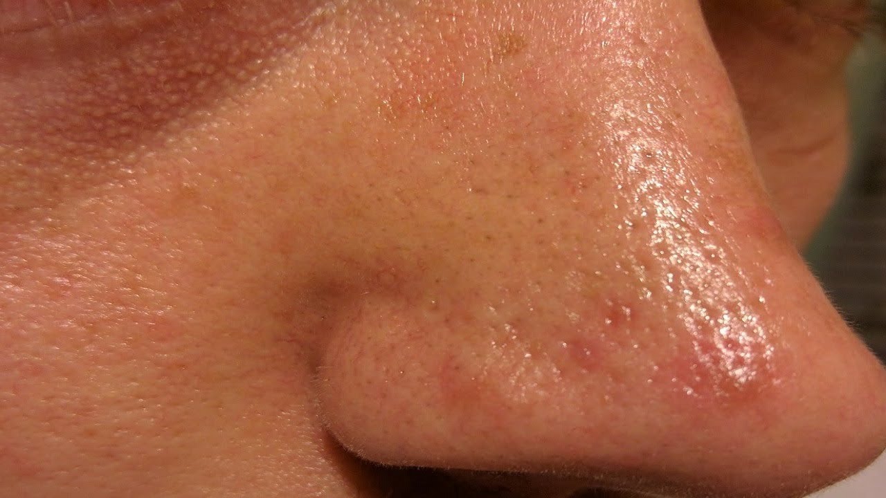 how to get rid of an oily nose in only 2 minutes - YouTube