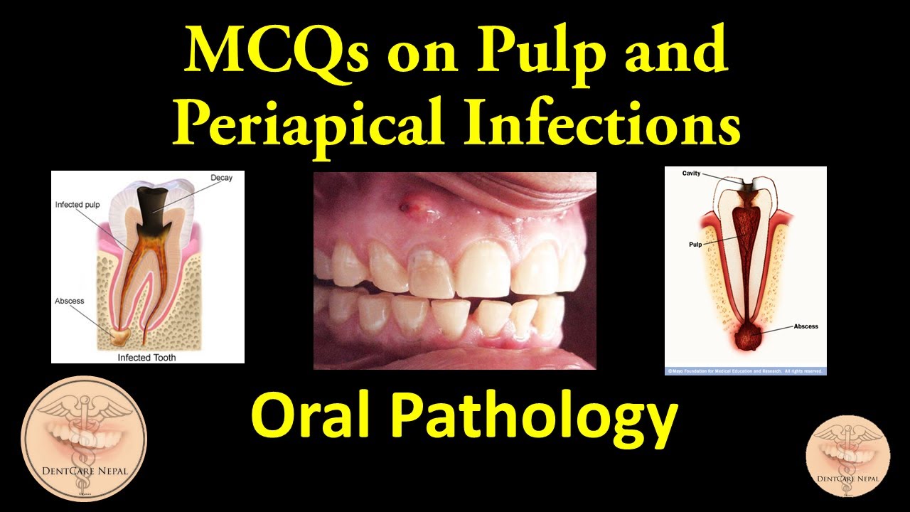 MCQs in Oral Pathology - Pulp and Periapical Infections - YouTube