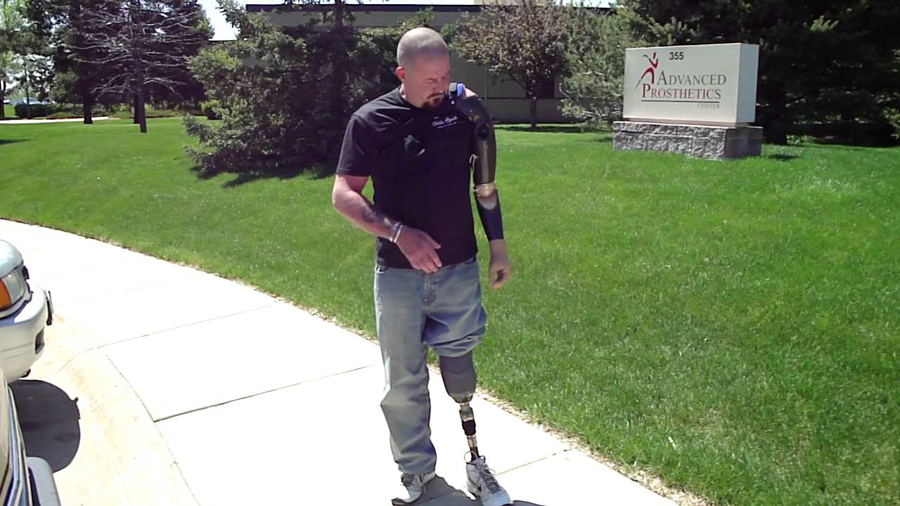 Final Otto Bock dynamic arm fitting. Carbon frame socket with ...