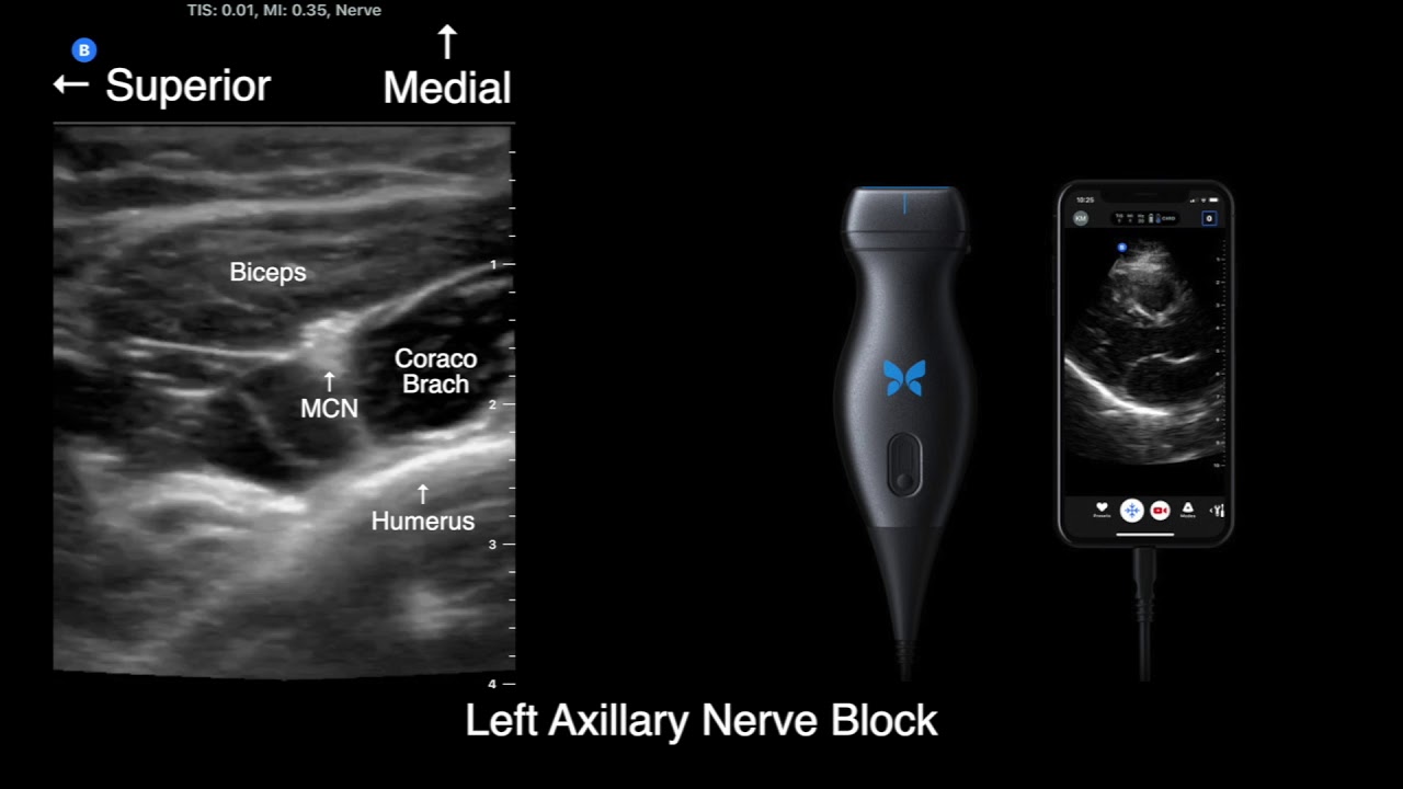 US anatomy for axillary nerve block with Butterfly-IQ - YouTube