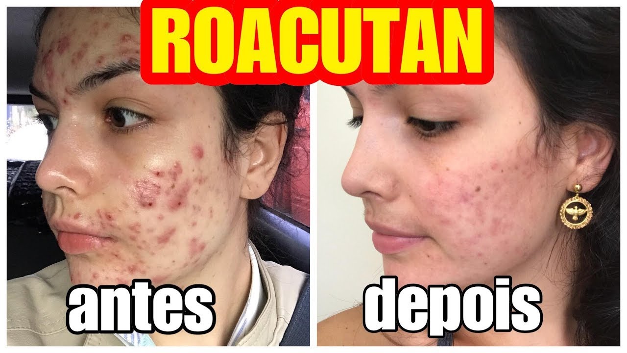 MINHA EXPERIÊNCIA COM ROACUTAN - YouTube