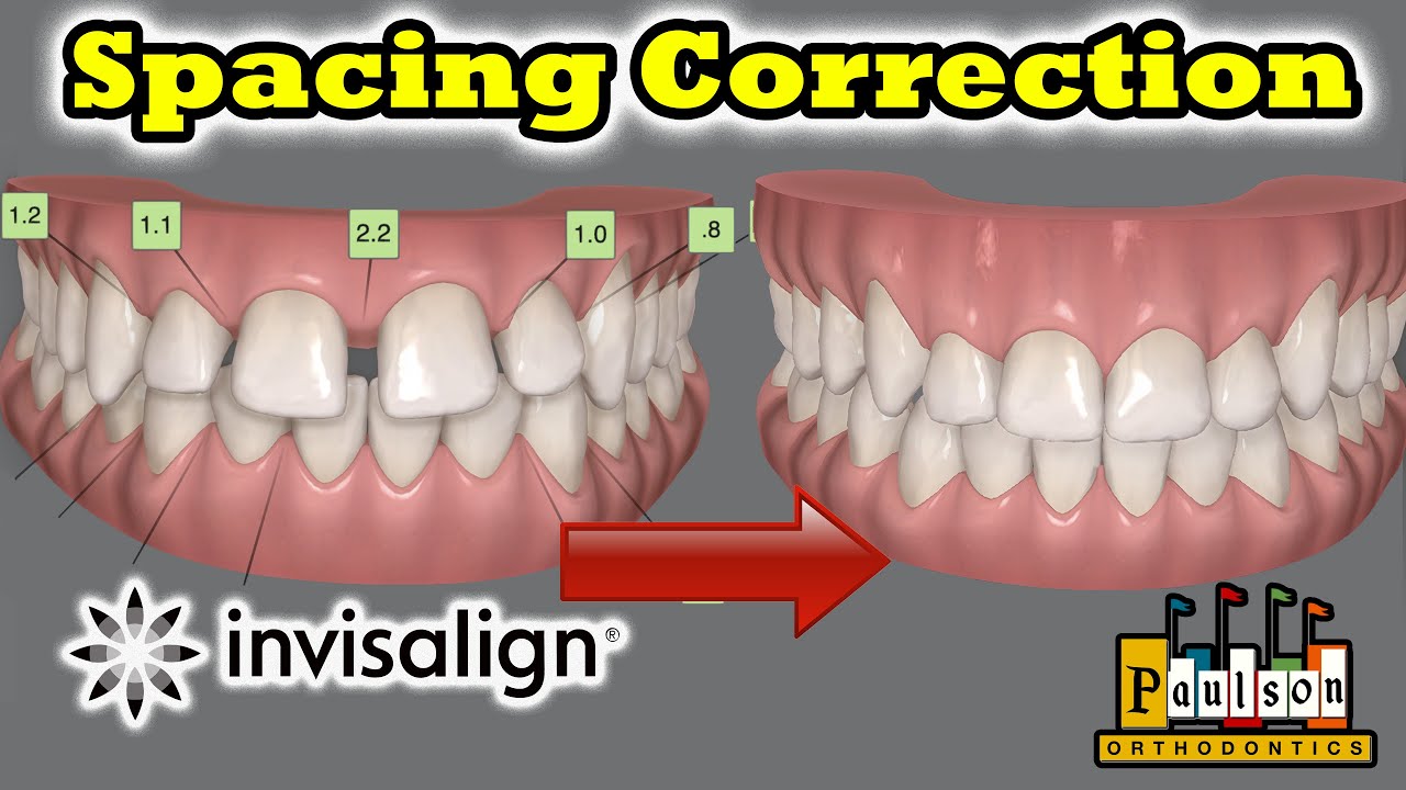 Teeth Spacing correction using Invisalign - Corrected with out Braces ...