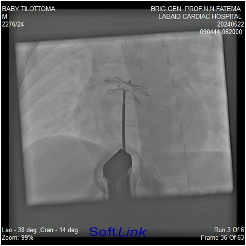 Tilottoma 2 Y 6 M 10Kg ASD device closure 14 mm Cocoon - YouTube