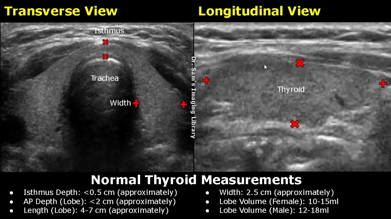How To Measure Thyroid On Ultrasound Length Width AP Depth Volume How To Measure Thyroid On Ultrasound Length Width AP Depth Volume
