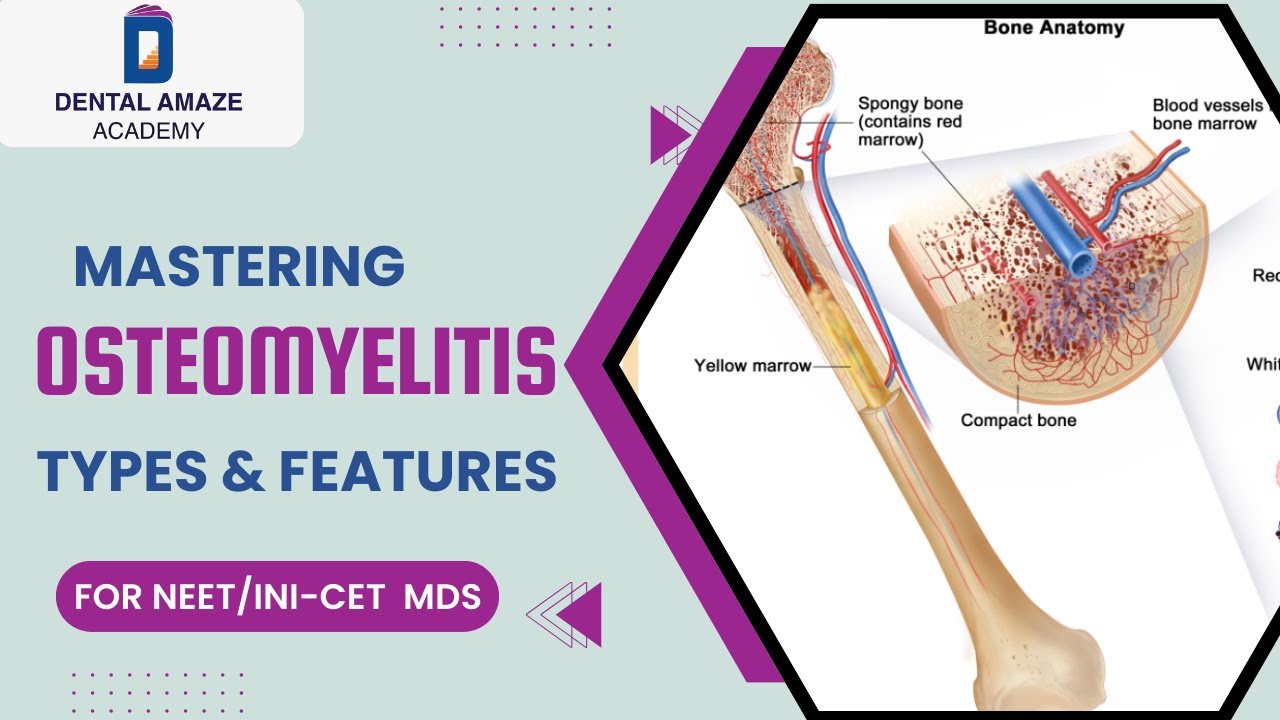 Mastering Osteomyelitis (Types & Features) For NEET/INI-CET MDS - YouTube