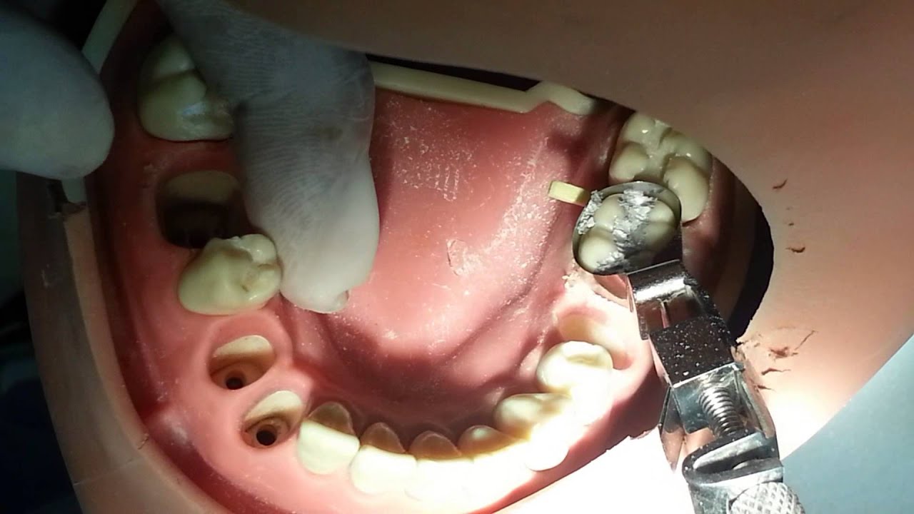 Amalgam filling for class 2 - YouTube