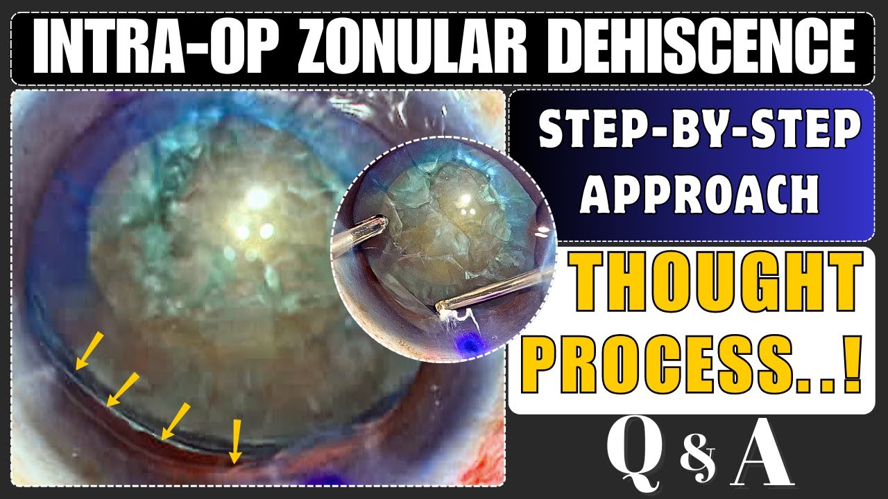 Intra-Op Zonular Dehiscence - Step-by-Step Approach, Questions ...