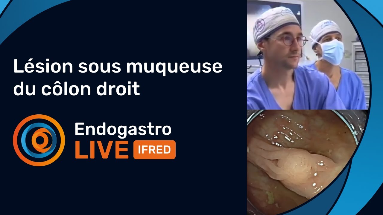 Lésion sous muqueuse du côlon droit - YouTube