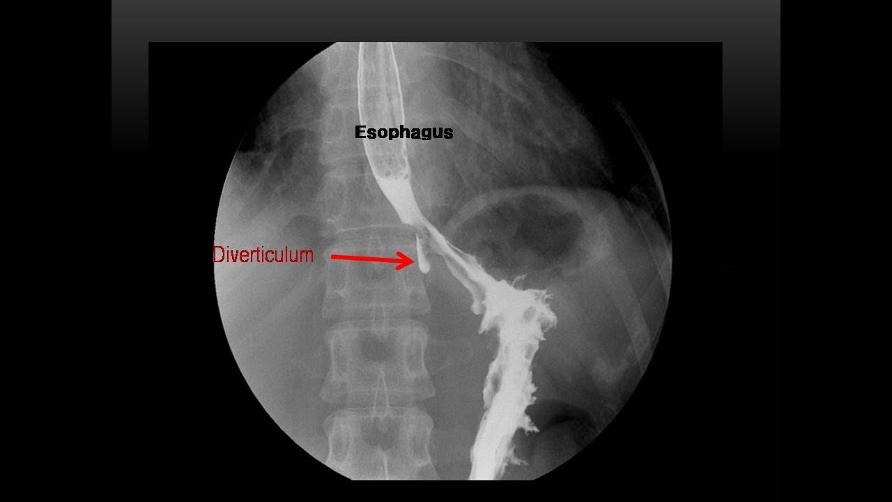 Distal Esophageal Diverticulum Ultrasonography 하부식도 게실 Youtube