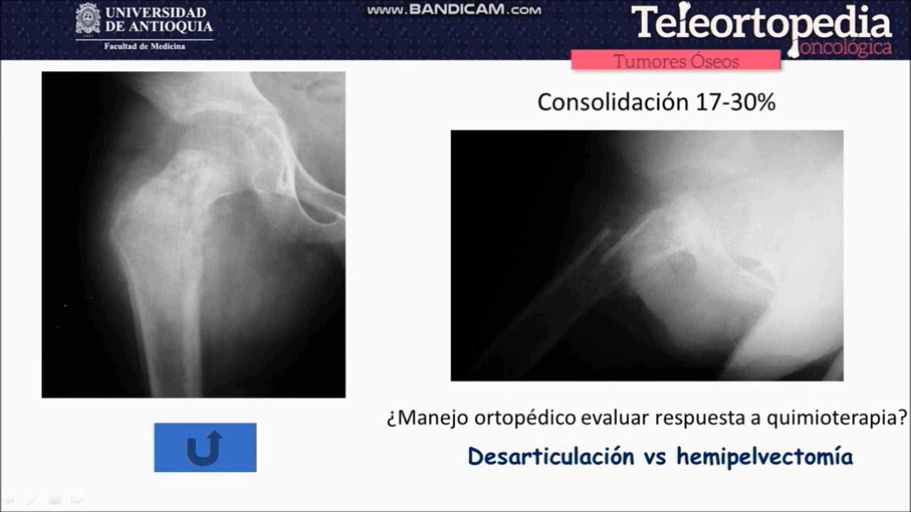 Fracturas patológicas Dr Jorge López mp4 - YouTube