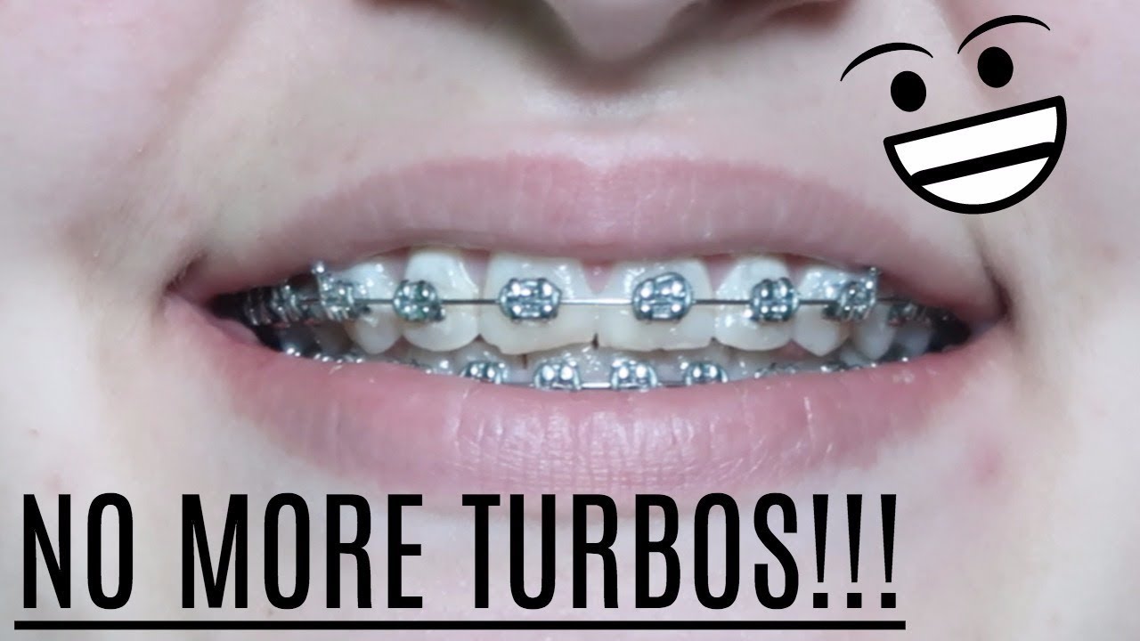 Braces Update! - 4 Months - YouTube