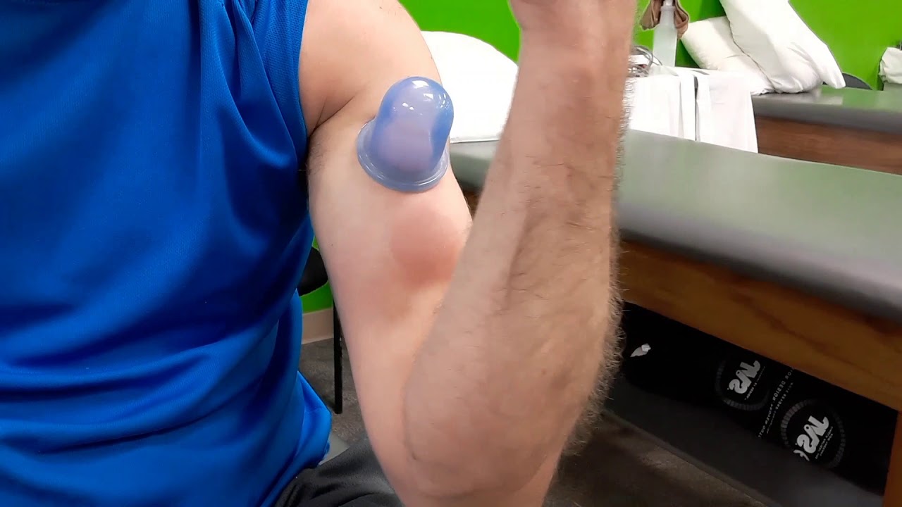 Cupping Biceps - YouTube