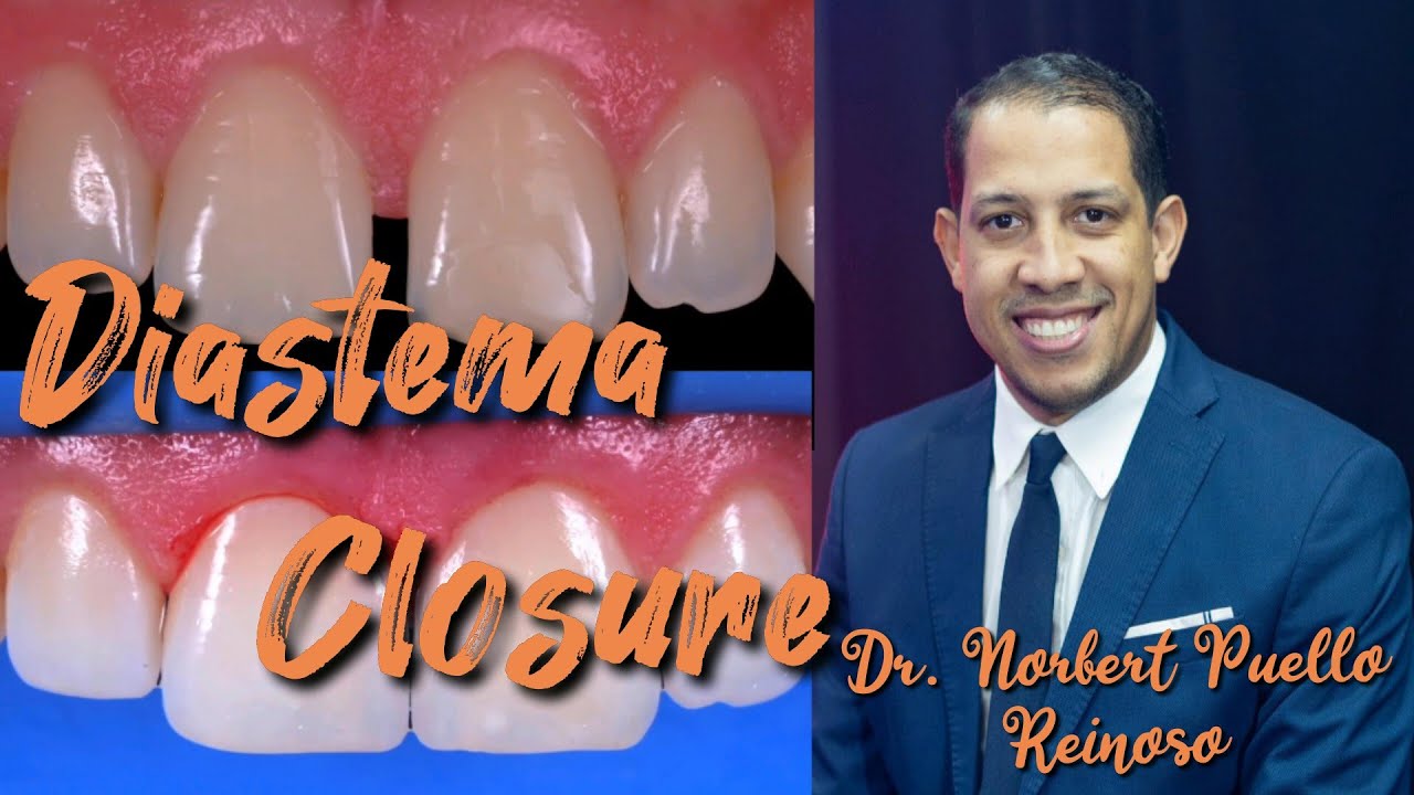 Diastema closure. Composite restoration front teeth. Dr. Norbert Puello ...