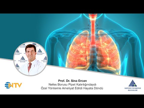 Koronavirüs Sonrası Daralan Nefes Borusu Özel Yöntemle Ameliyat Edildi / Prof. Dr. Sina Ercan