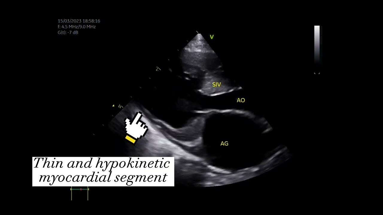 Hypokinetic hypertrophic cardiomyopathy in 6 year-old cat - YouTube