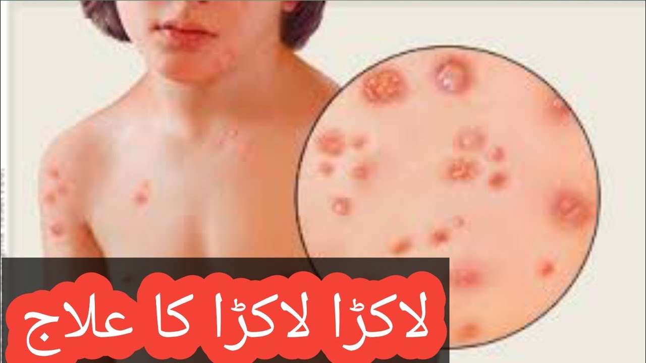 Calamine lotion | lakra kakra treatment in urdu | lakra kakra ka ilaj ...