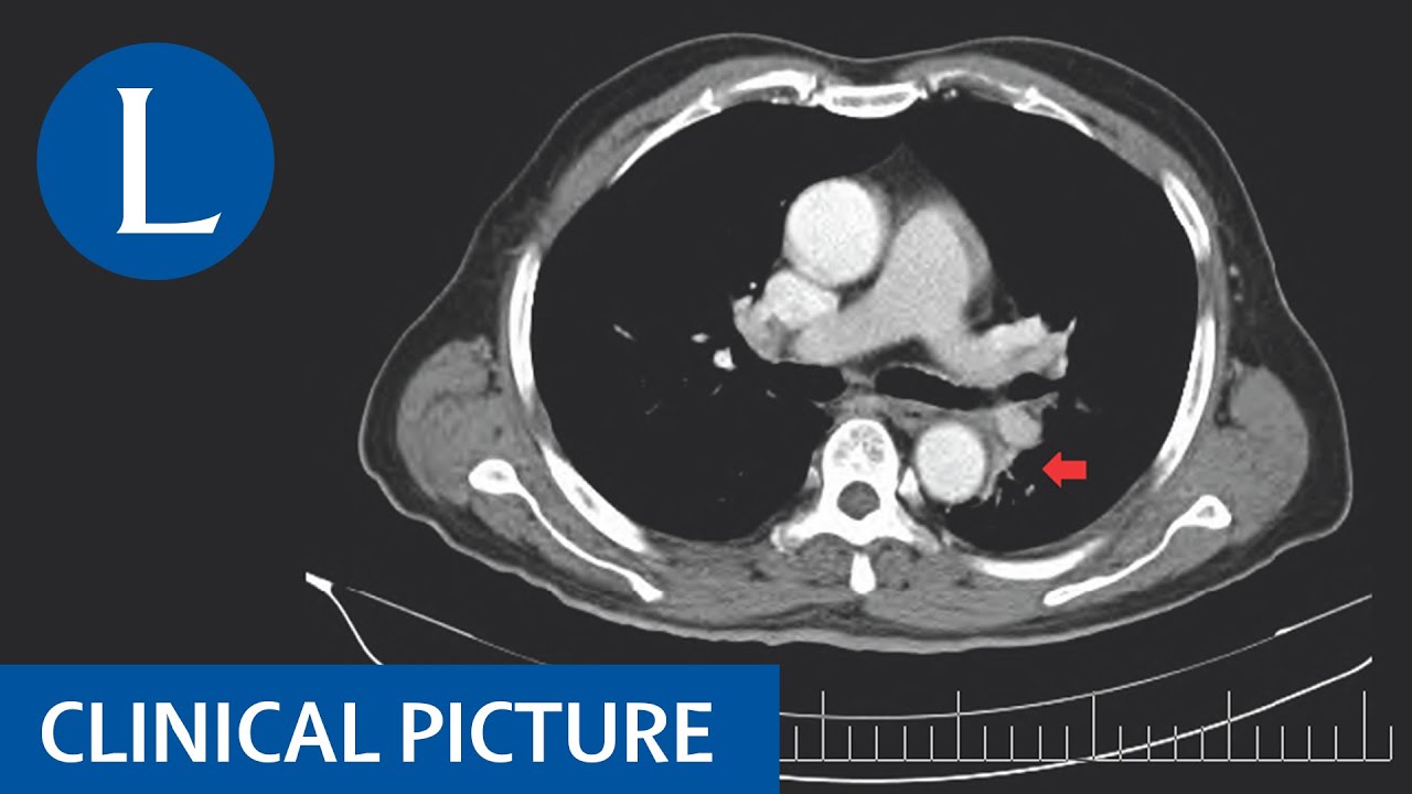 Diagnosing A Mediastinal Mass Youtube