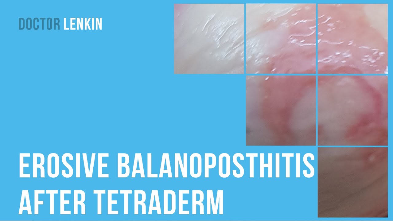 😟 Erosive balanoposthitis after tetraderm - YouTube