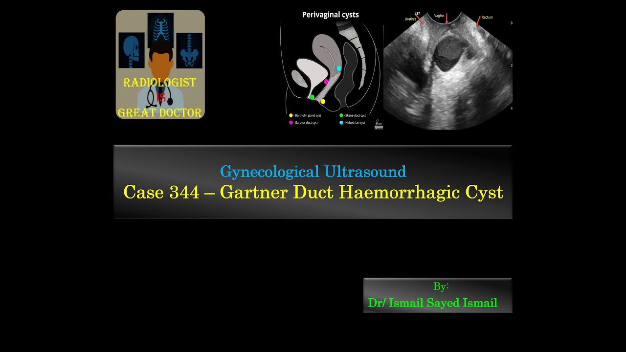 Ultrasound Case 344 - Gartner Duct Haemorrhagic Cyst - YouTube