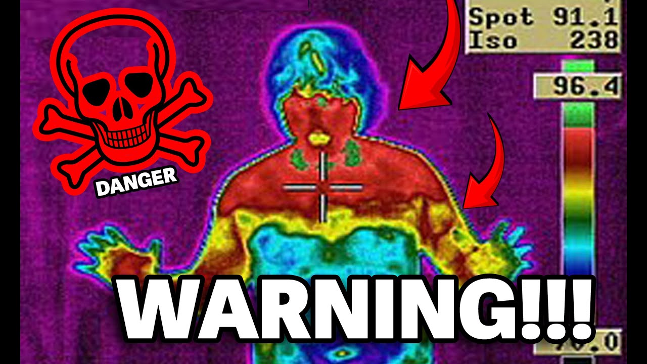 ETS Hyperhidrosis Surgery SIDE EFFECTS! - Life Destroying ...