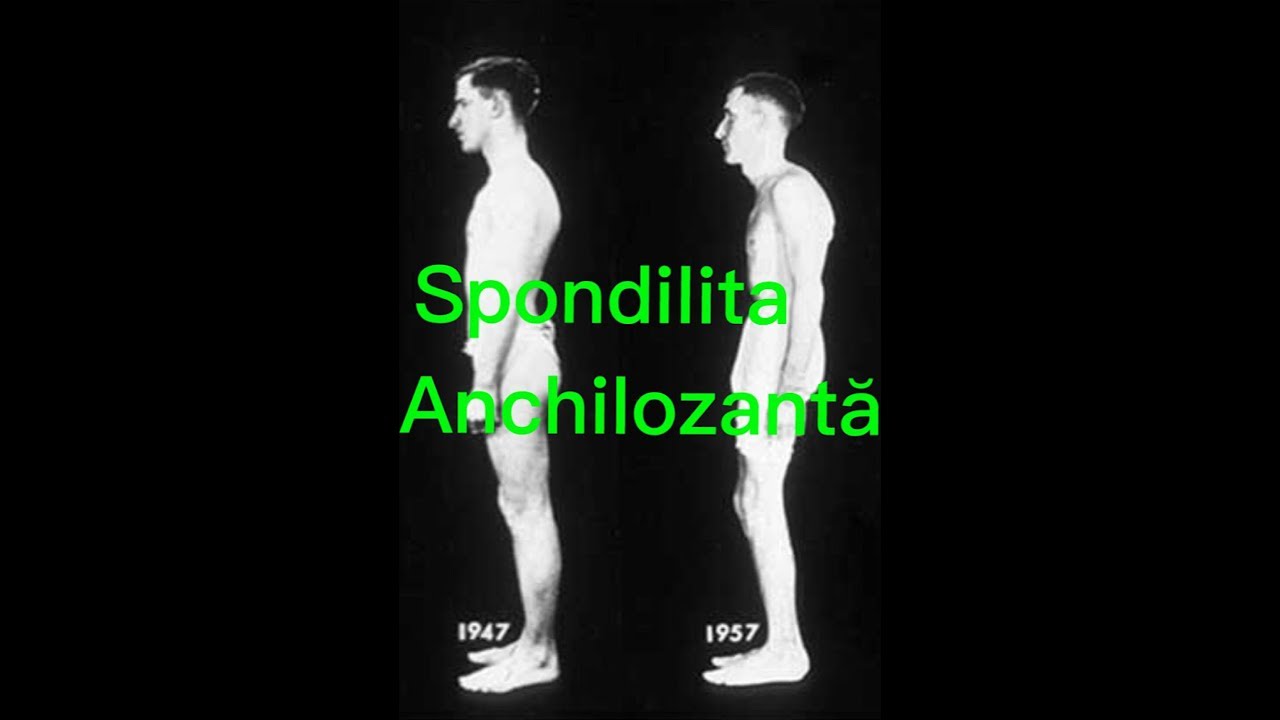 SPONDILITA ANCHILOZANTA - Ne naștem sau o dobândim ? - YouTube
