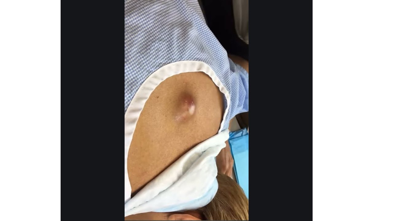 Satisfying Cysts & Sac removals. Sooo relaxing #satisfyingvideos # ...