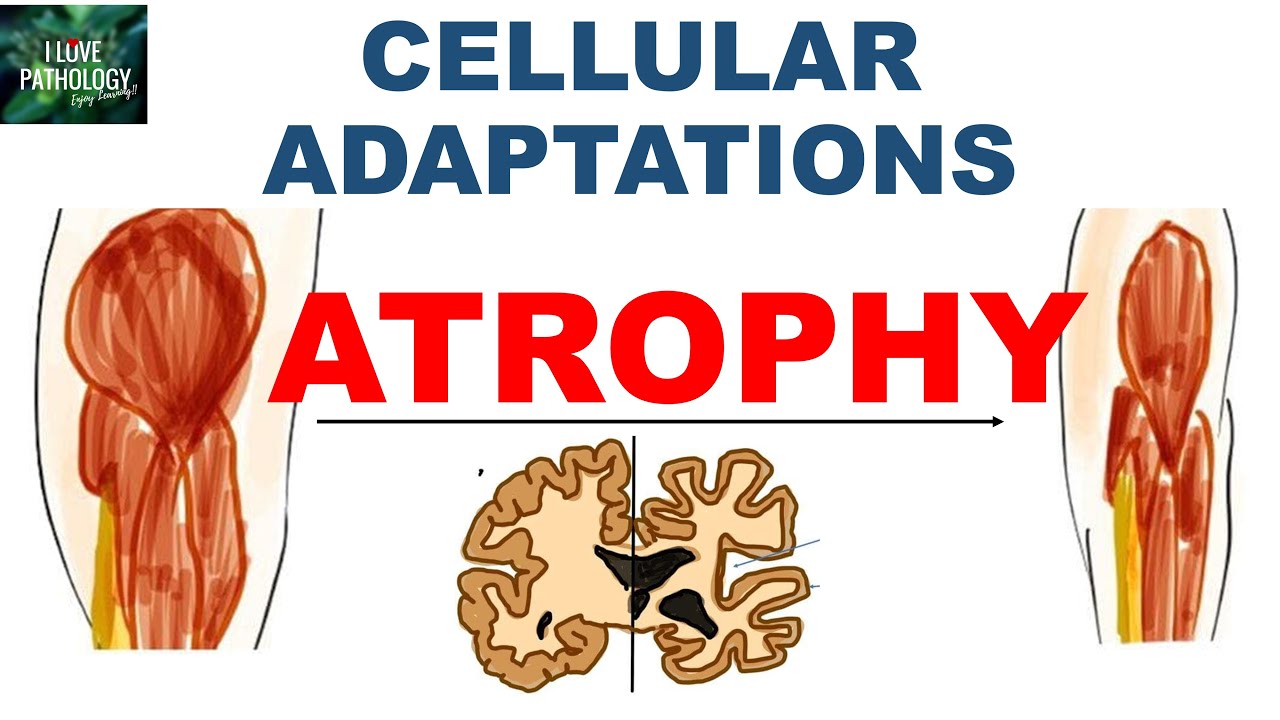 Cellular Adaptations: ATROPHY- Types, Mechanism & Consequences - YouTube