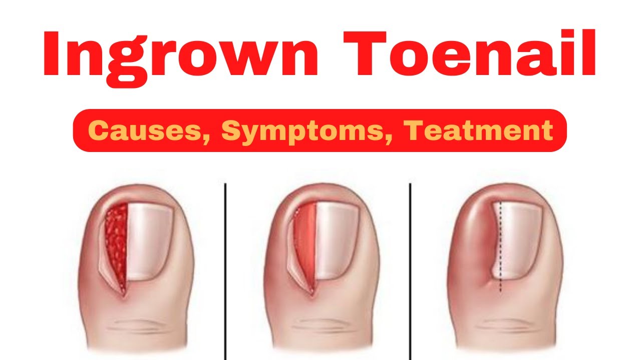 Ingrown Toenail: Causes, Symptoms and Treatment - YouTube