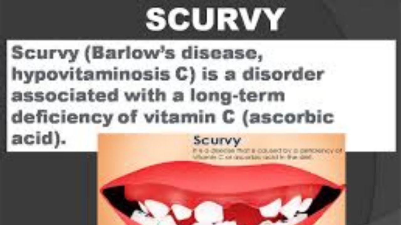 How to treat Scurvy | Scurvy ka homeopathic ilaj | Scurvy ka ilaj kaise ...
