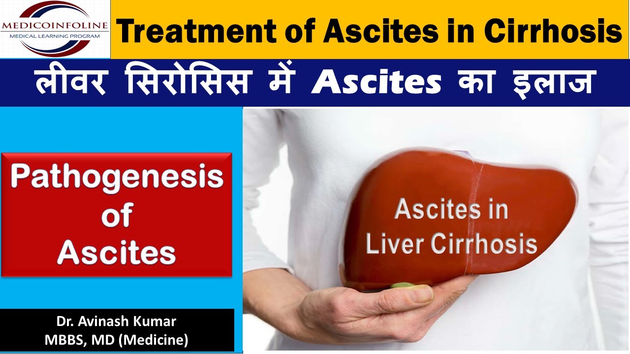 Pathogenesis & Treatment of Ascites in Liver Cirrhosis - YouTube