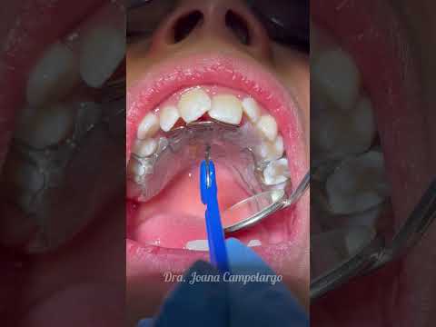Expansor Tipo Hass: Una Solución Para La Mordida Cruzada | Ortodoncia Junin