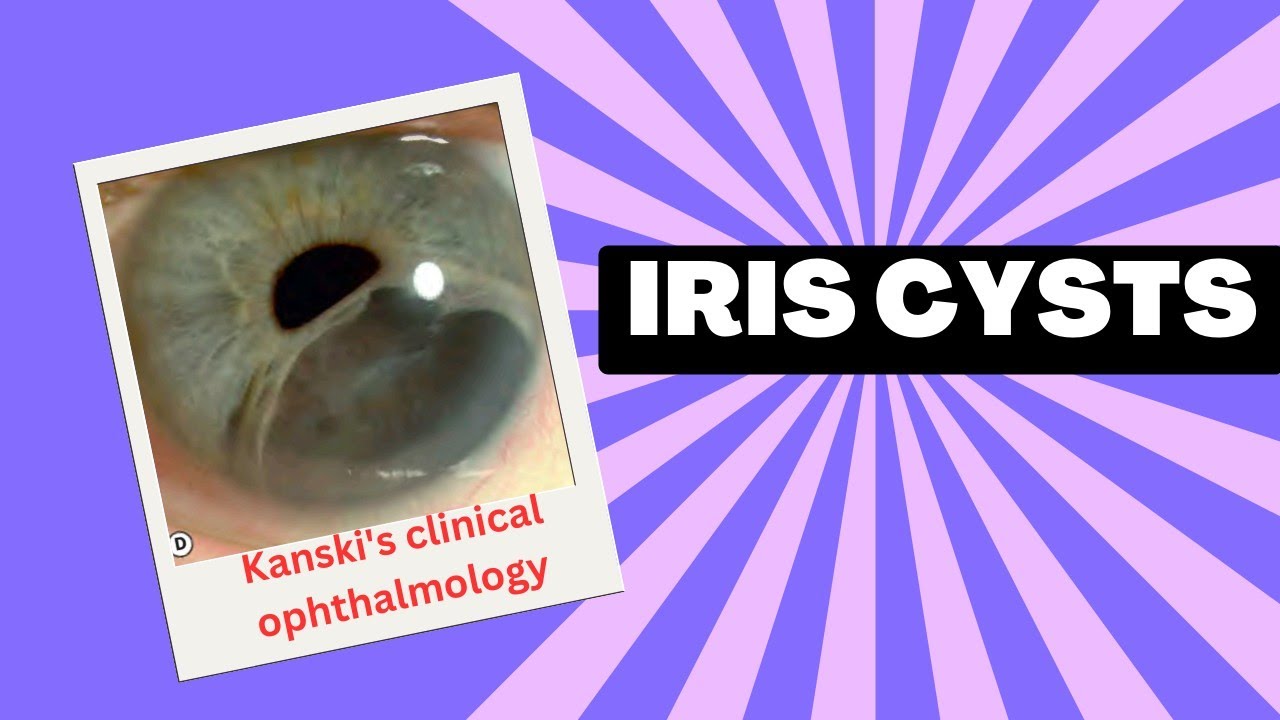 Iris cysts-Kanski's clinical ophthalmology #ocular tumors # ...