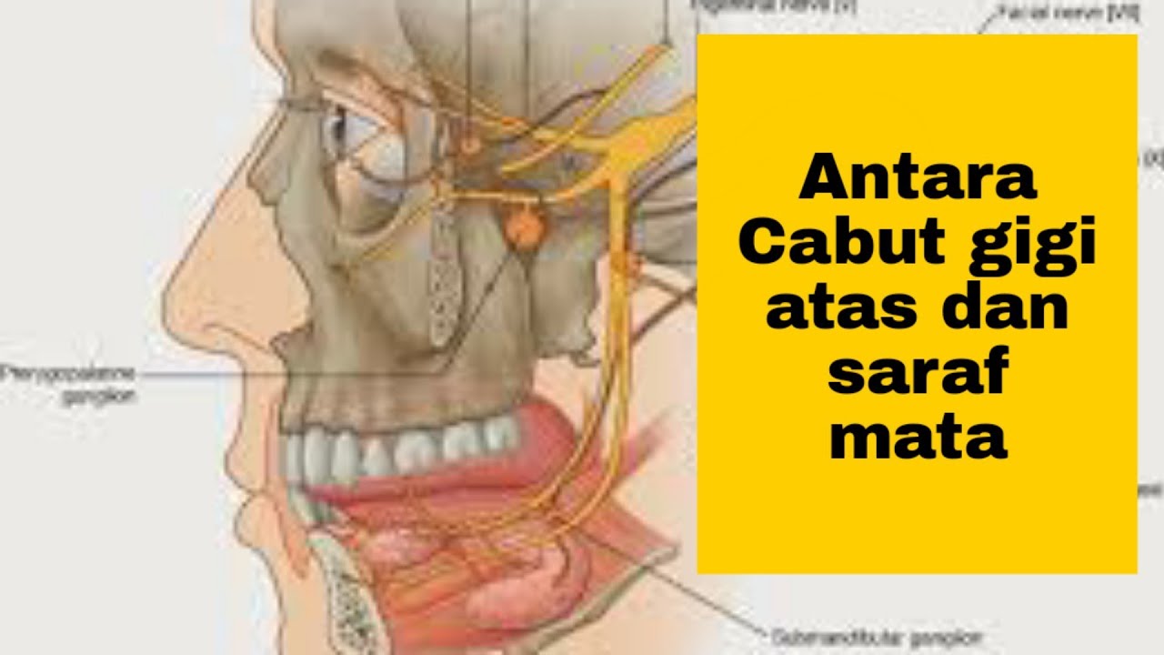 Fakta Cabut Gigi Atas dan Saraf Mata - YouTube