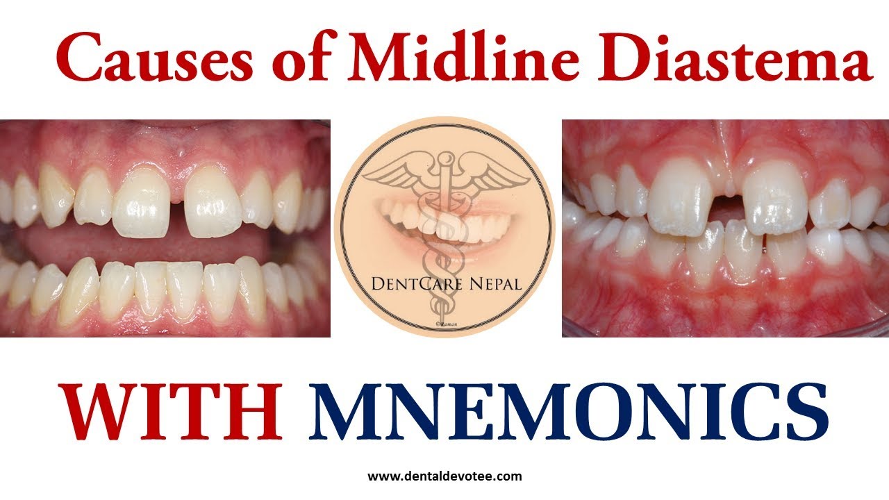Causes of Midline Diastema With Mnemonics - Dental Spacing Causes - YouTube