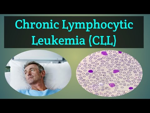 Chronic Lymphocytic Leukemia (CLL) | Smear | Special Smear | Blast ...