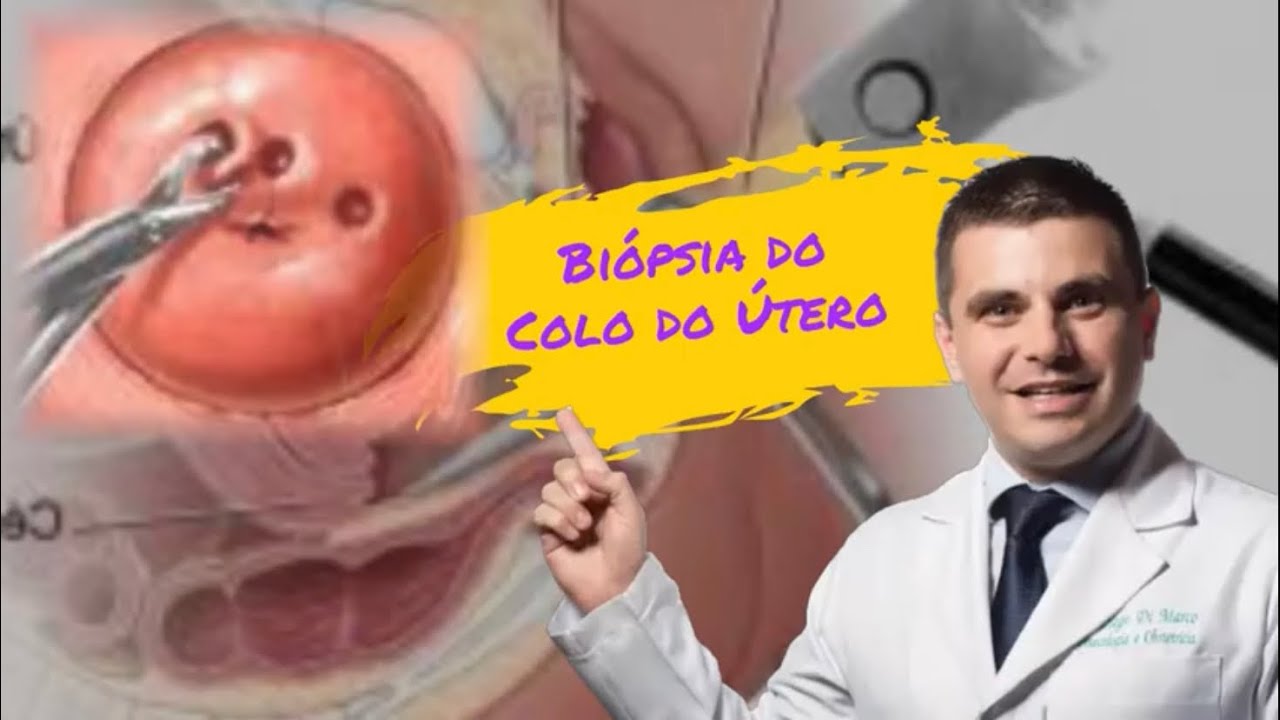 Biópsia do colo uterino - YouTube