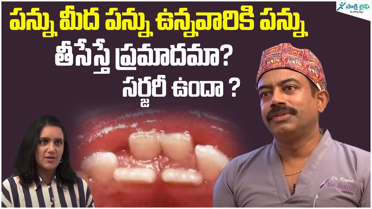 Overlapping teeth - Causes, issues and treatment | Dr. Koya Kishore ...