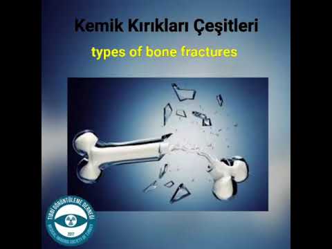 KIRIK ÇEŞİTLERİ NEDİR TYPES? OF BONE FRACTURES