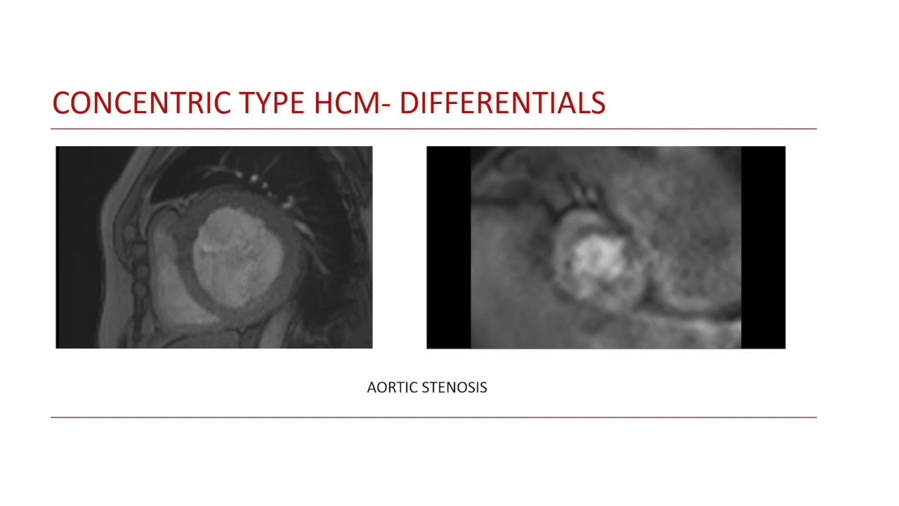 14. CMR Assessment of HCM Dr Bhavana - YouTube