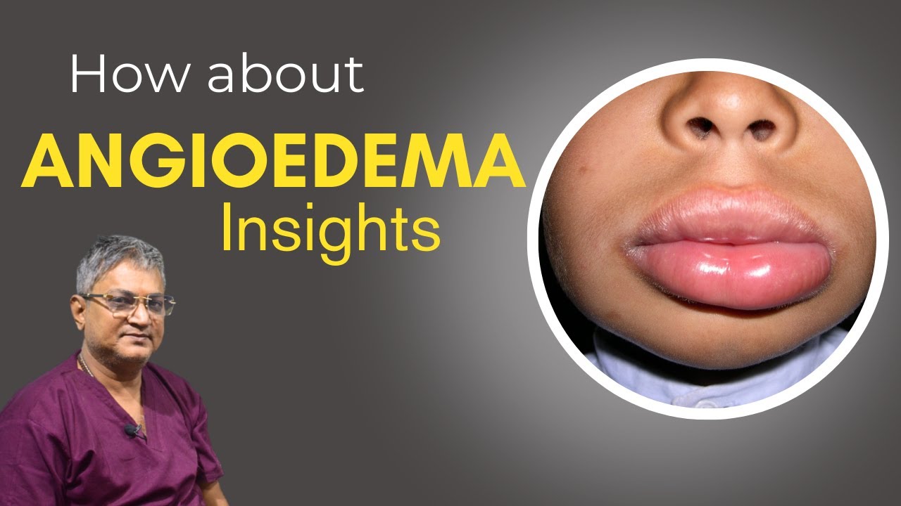 "Understanding Angioedema: The Hidden Dangers of Allergic Angioedema ...