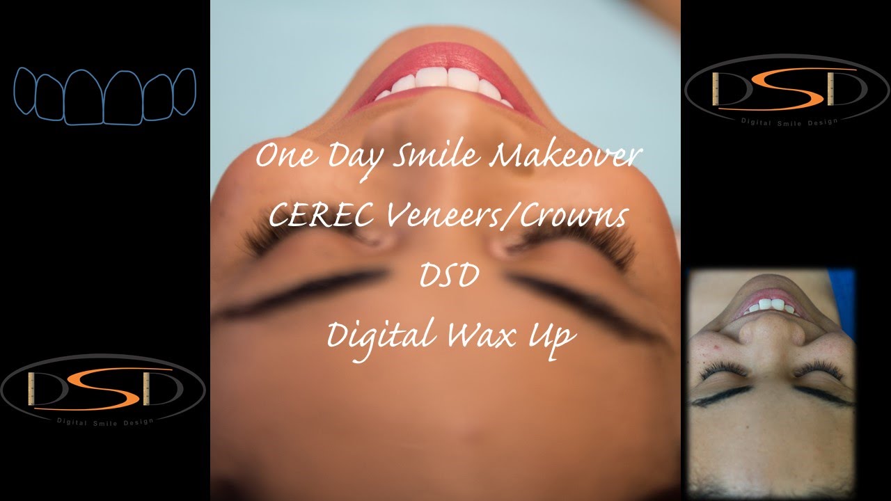 CEREC Omnicam DSD Veneers Crowns One day Smile Makeover - YouTube